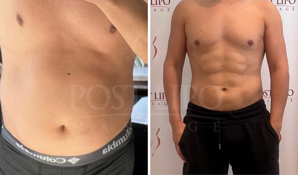 Before And After Cs Post Lipo Massage